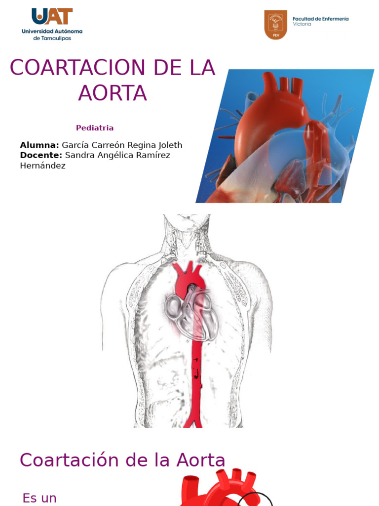 Coartacion de La Aorta | PDF