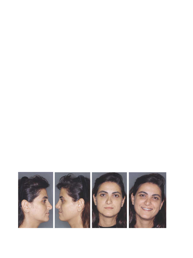 Cleft Lip and Palate Management With Maxilla - 2000 - American Journal ...