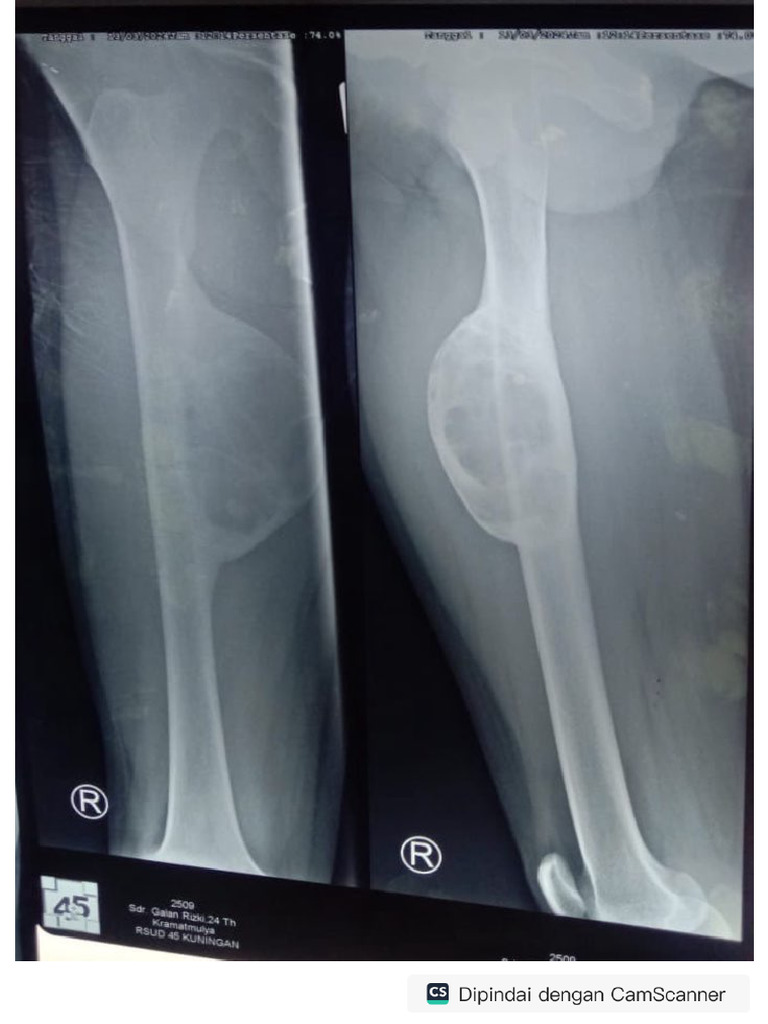 Diagnosa Tumor dan Infeksi Paru | PDF