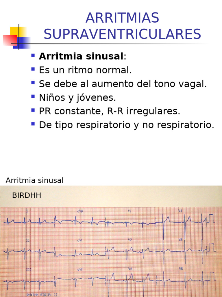 Arritmias Supraventriculares. | PDF | Electrocardiografia | Medicina CLINICA