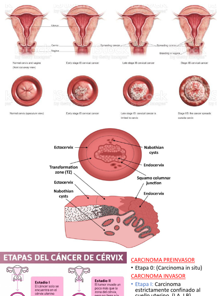 Etapas del cáncer cervicouterino | PDF