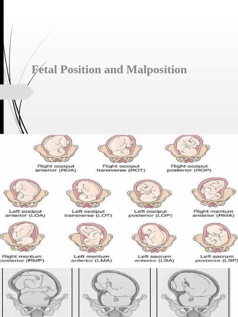 Fetal Position and Malposition ST D | PDF | Childbirth | Caesarean Section