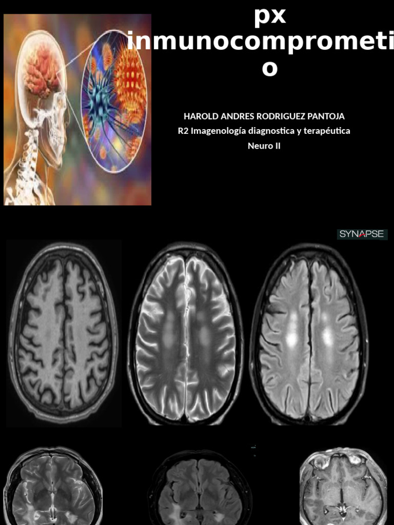 Infecciones SNC en Pacientes Inmunocomprometidos | PDF | Epidemiología ...