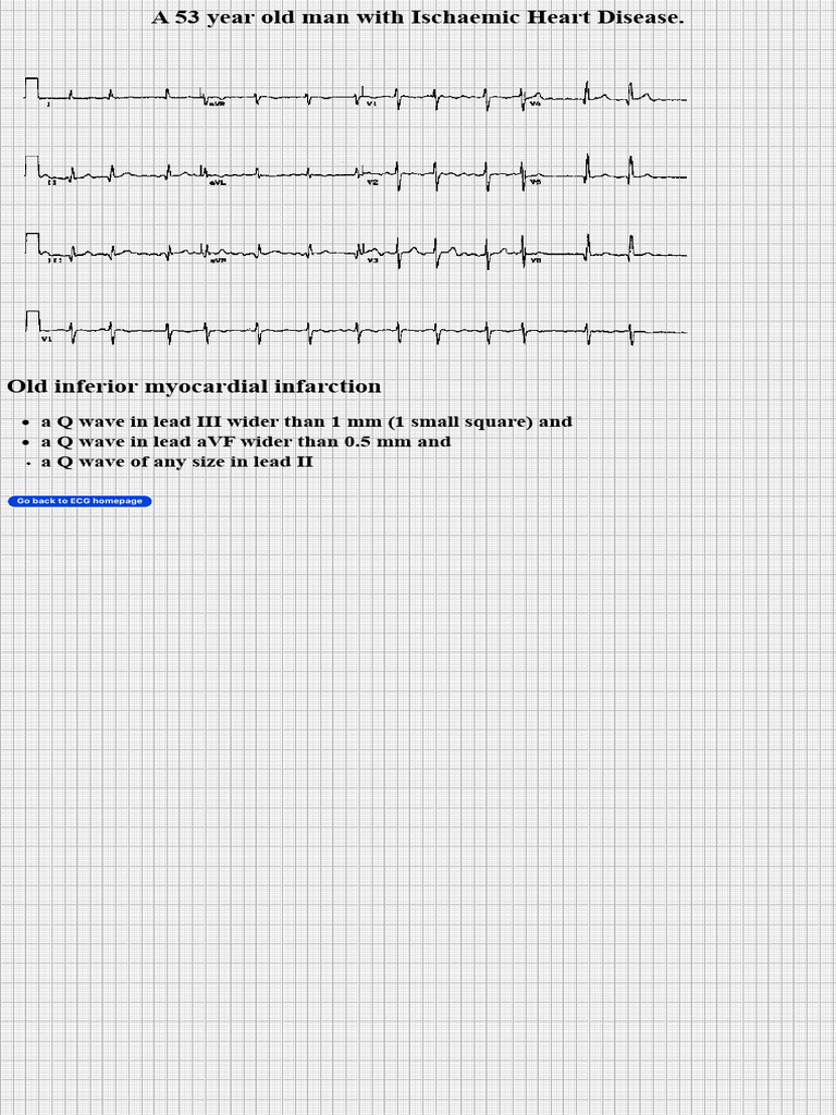 Old Inferior Myocardial Infarction | PDF