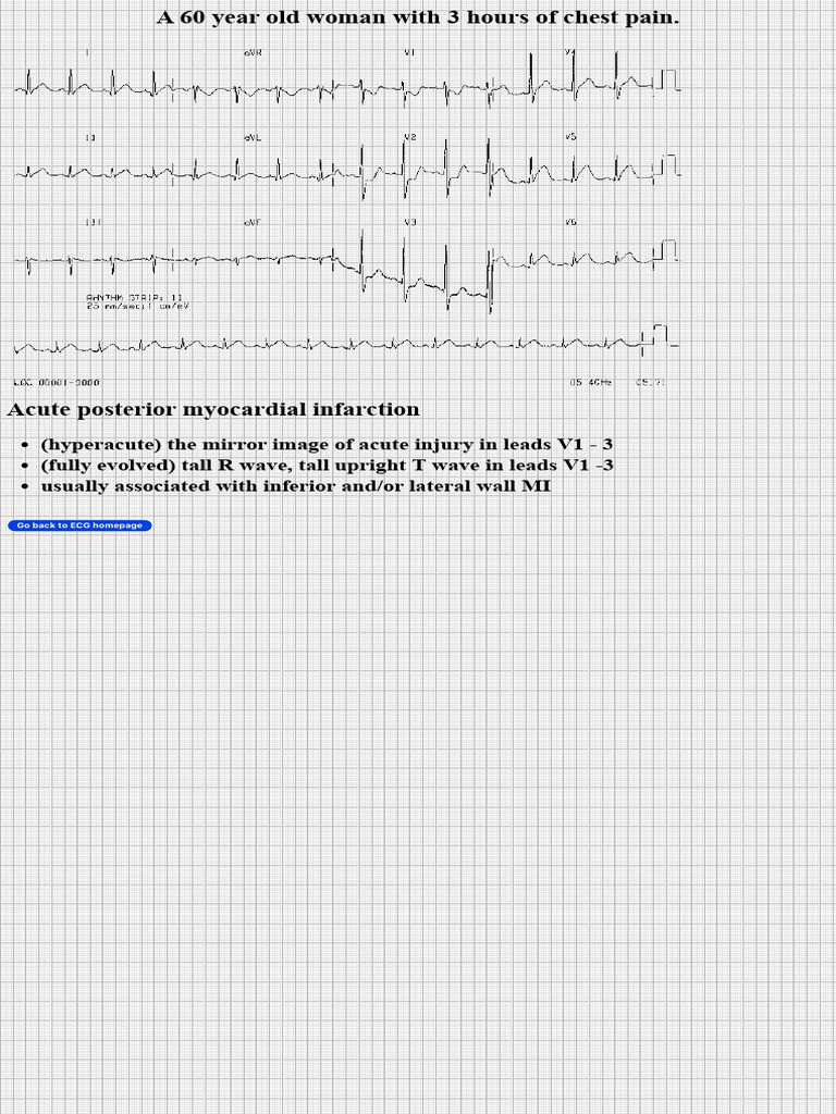Acute Posterior Myocardial Infarction | PDF