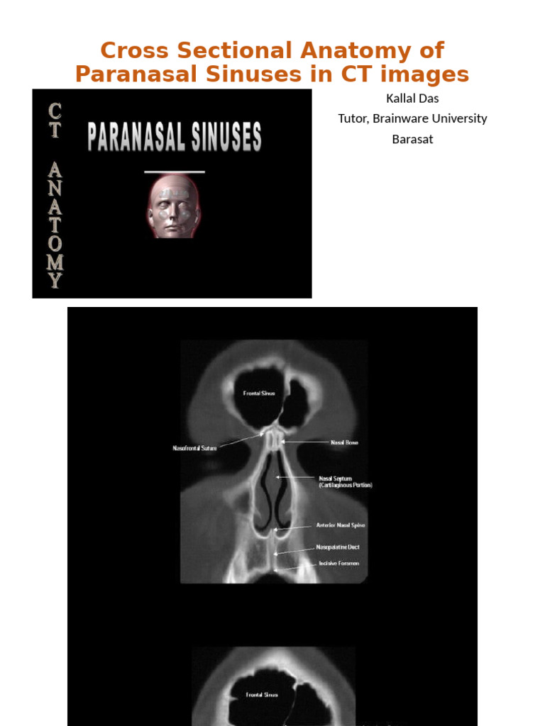 Cross Sectional Anatomy of Paranasal Sinuses in CT | PDF