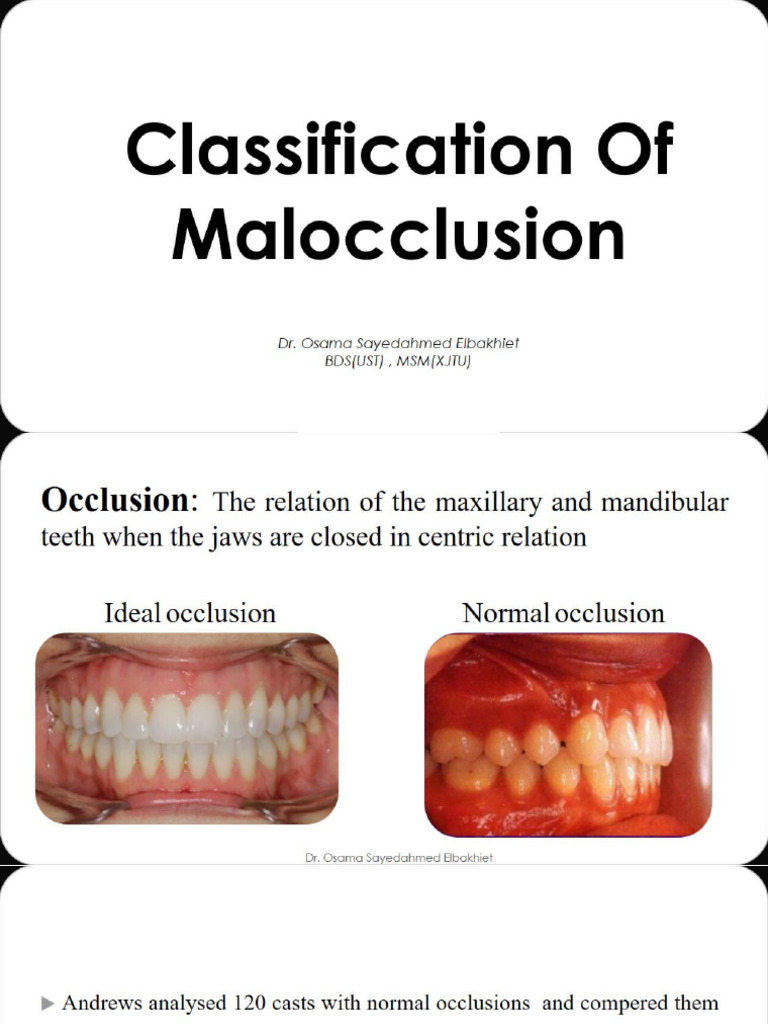 Classification of Malocclusion | PDF