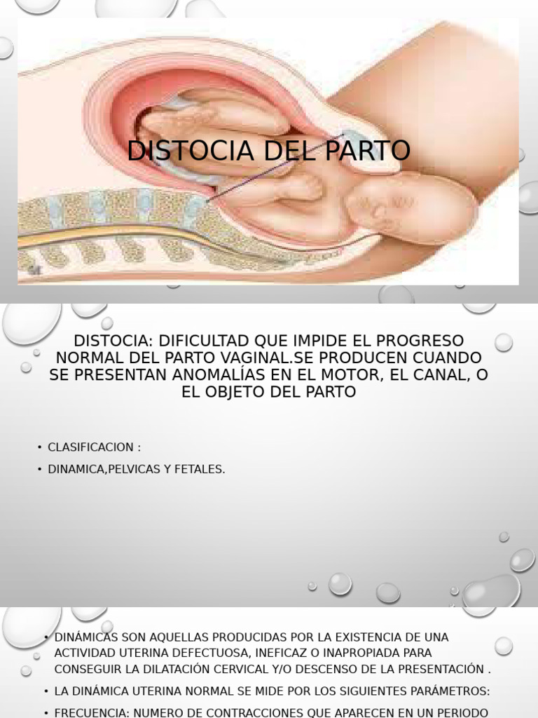 Distocia Del Parto | PDF | Parto | La salud de la mujer