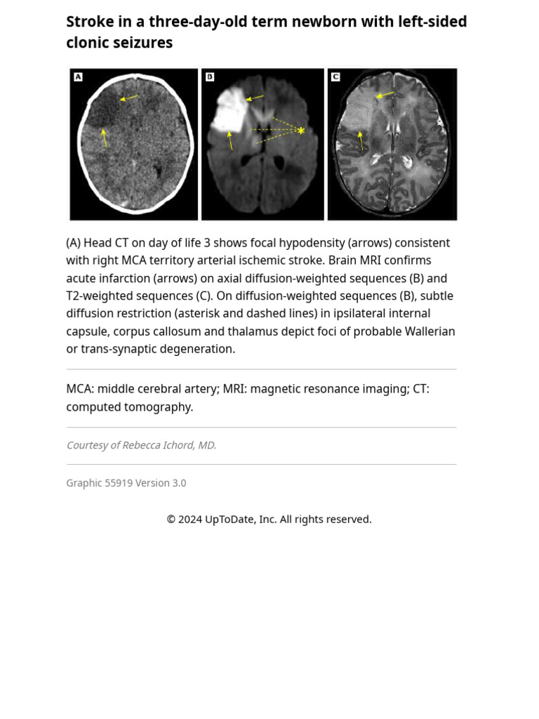 Newborn Stroke with Clonic Seizures | PDF