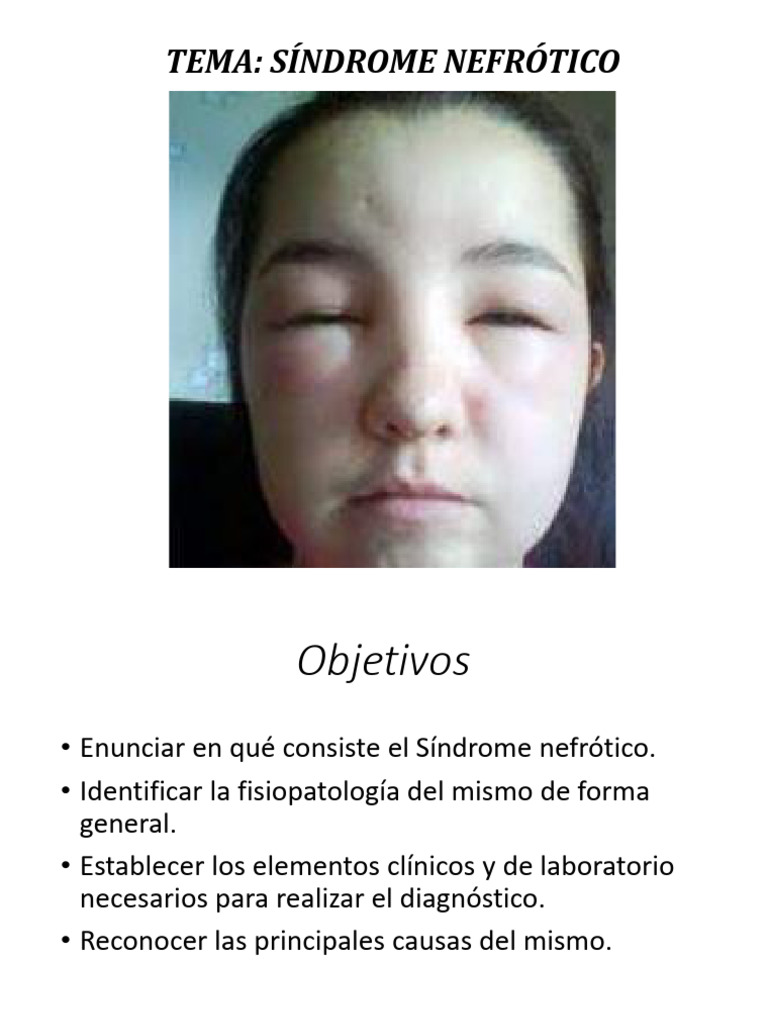 Síndrome Nefrótico | PDF | Edema | Enfermedades y trastornos