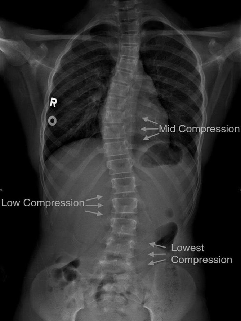 Cassy B Scoliosis | PDF