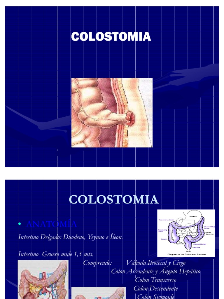 Tipos de Colostomía y Técnicas Quirúrgicas | PDF | Intestino grueso ...