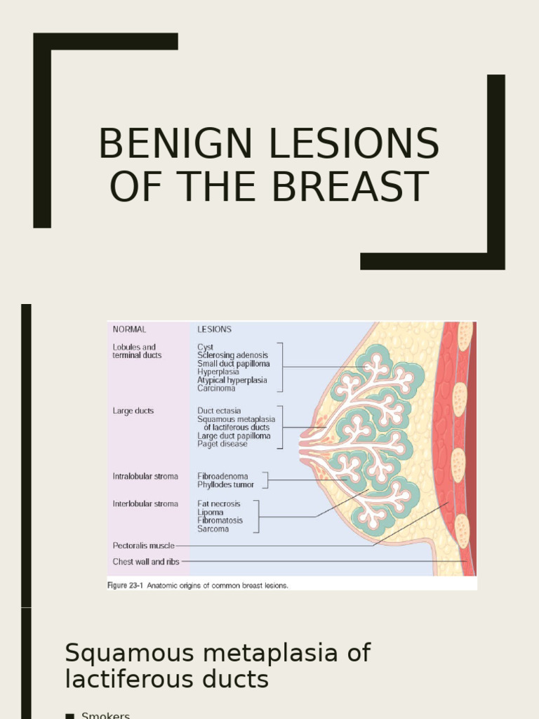 Benign Breast Lesions Overview | PDF | Epithelium | Carcinoma