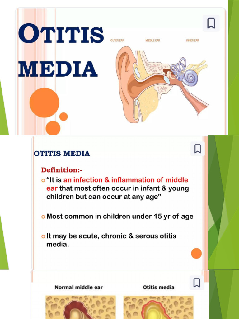 Otitis Media | PDF