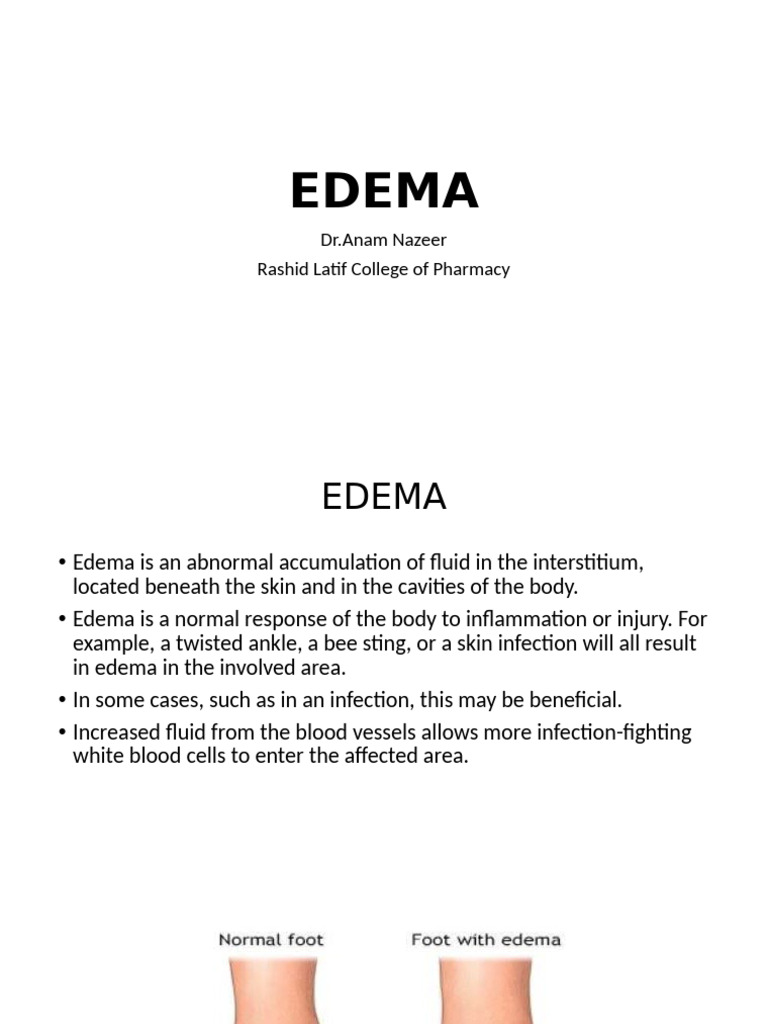 Edema | PDF | Edema | Medical Specialties
