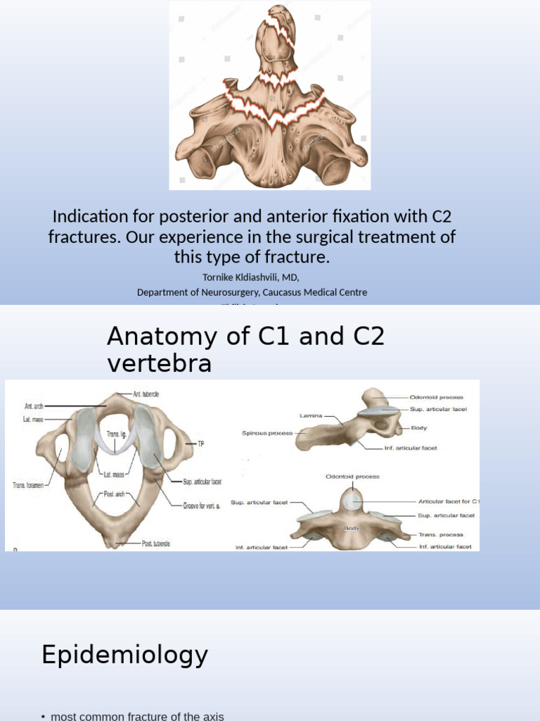 Indication for posterior and anterior fixation with C2 fractures. Our ...