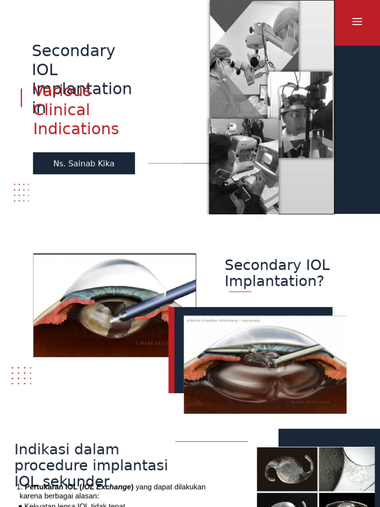 3 Sainab, Secondary IOL Implantation by QK | PDF