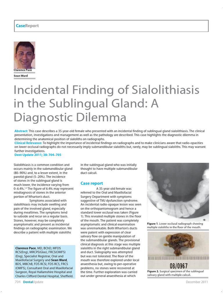 Sialolith | PDF | Diseases And Disorders | Medical Specialties