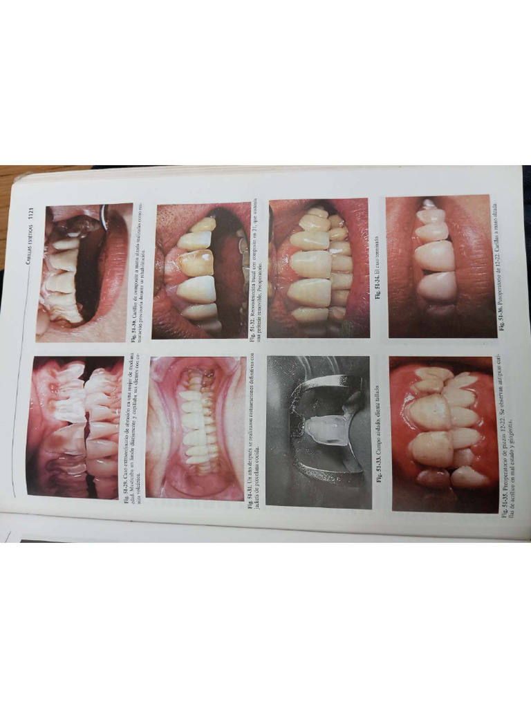 Abrasión Dental y Carillas de Composite | PDF