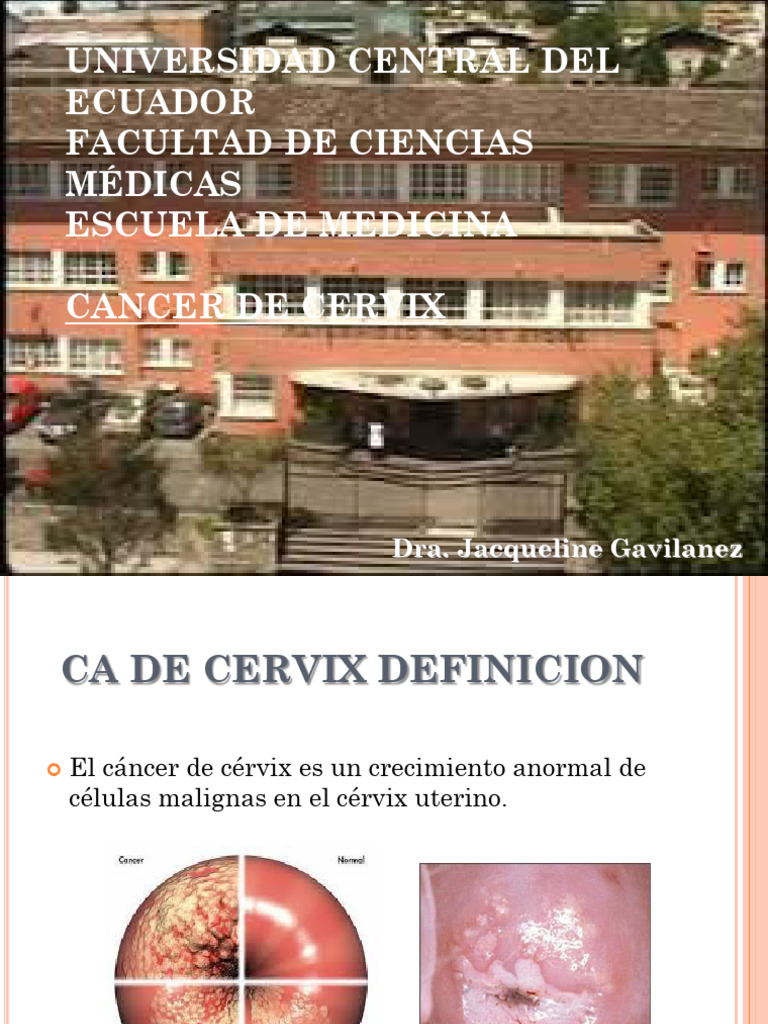 Cancer Cervix Final + HPV Actualizado-25-10-2017 | PDF | Cáncer de cuello uterino | Cáncer