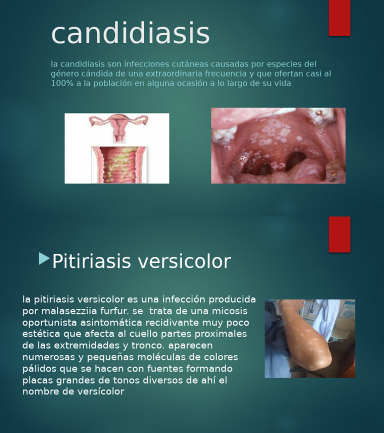 Candidiasis | PDF