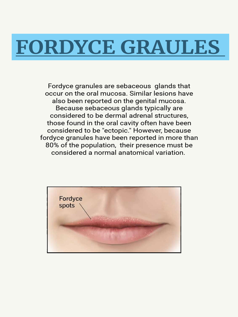 Understanding Fordyce Granules: Features & Facts | PDF