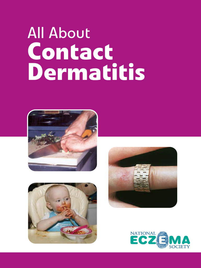 Understanding Contact Dermatitis Guide | PDF | Dermatitis | Dermatology