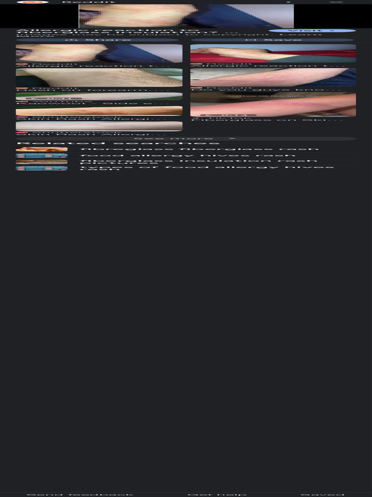 Fiberglass Rash - Google Search | PDF