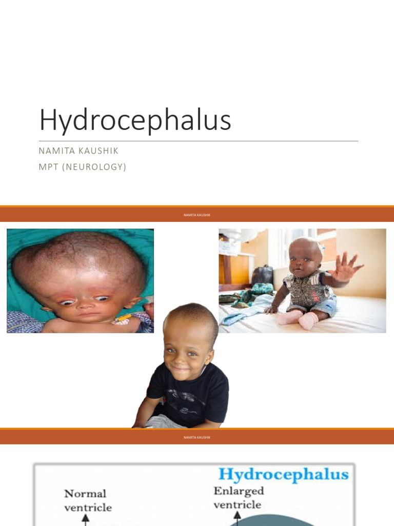 Hydrocephalus | PDF