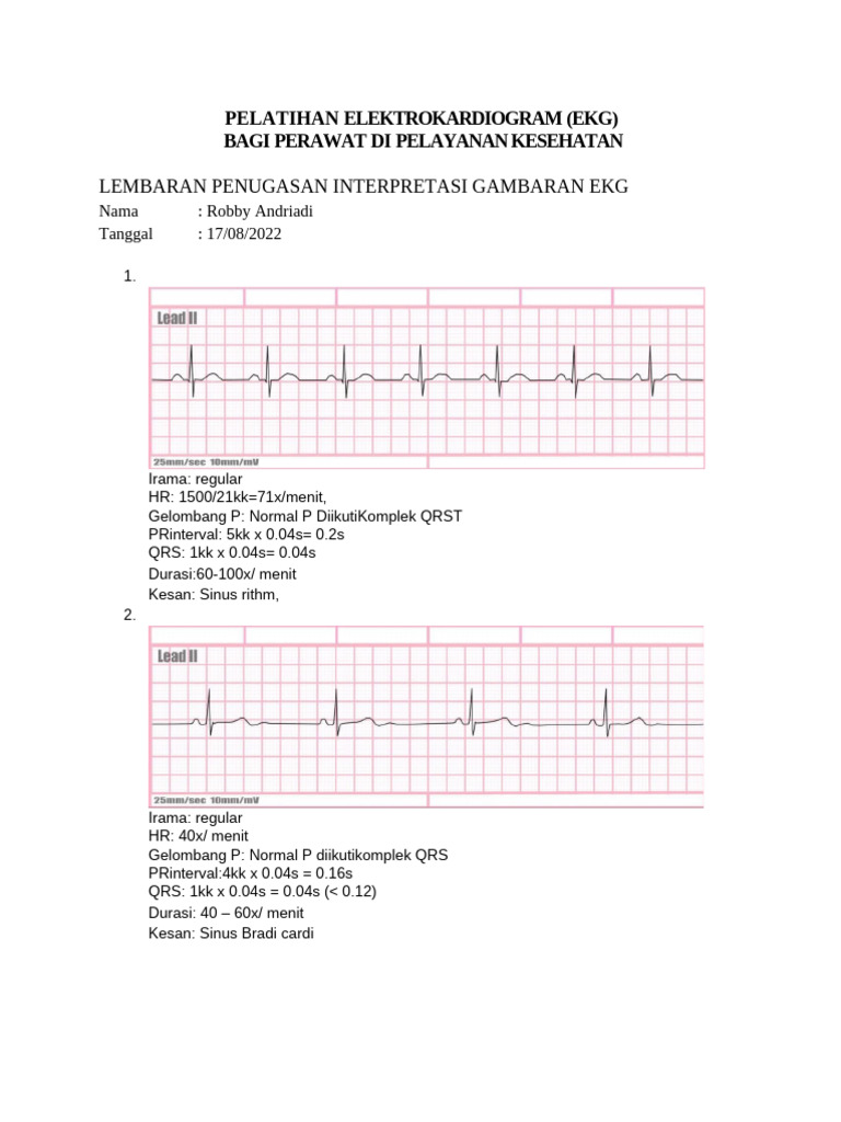 Interpretasi EKG Sinus Bradi Cardiac | PDF