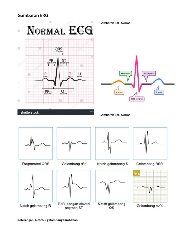 Gambaran EKG Normal Dan Pada Gangguan Jantung | PDF