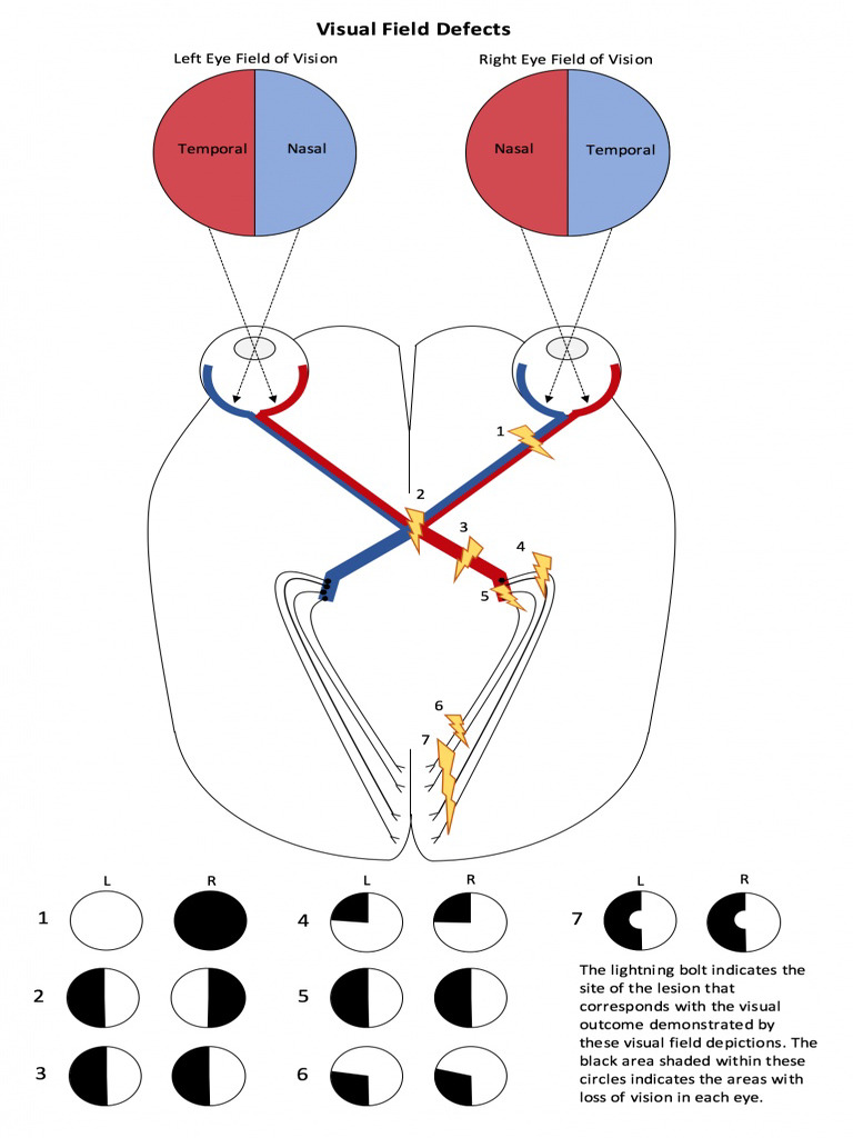 Visual Field Defects | PDF