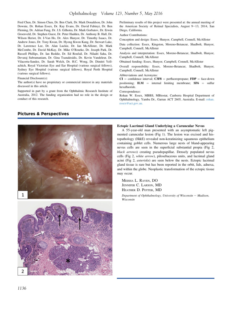 Ectopic Lacrimal Gland Underlying A Caruncular Nev | PDF | Human Eye ...