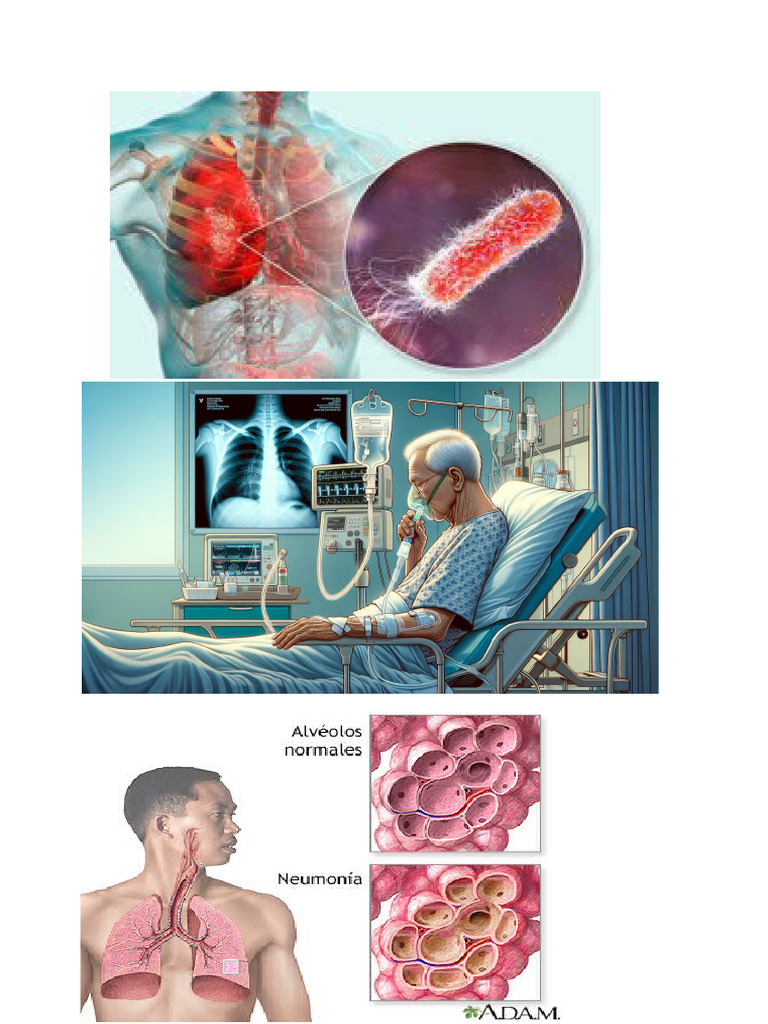 Guía Completa sobre la Neumonía | PDF | Neumonía | Influenza