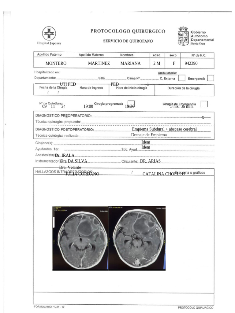 empiema subdural mariana montero[1] | PDF | Cirugía | Especialidades ...