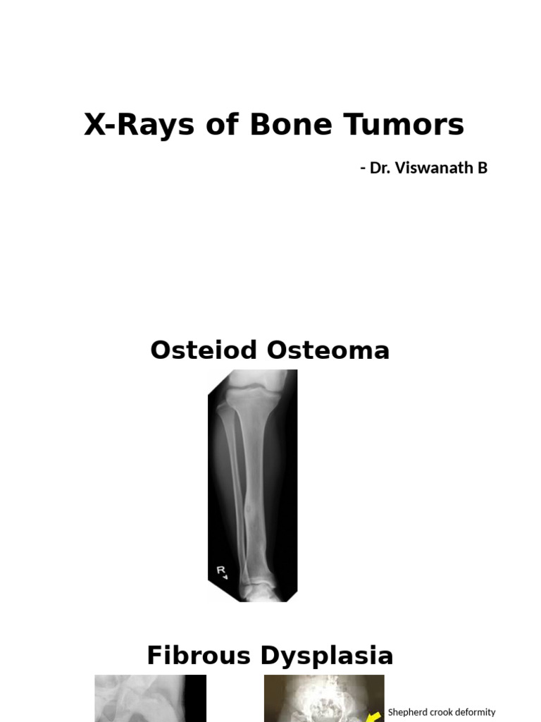 X-Rays of Bone Tumors.pptx - Dr. Viswanath B(1) | PDF