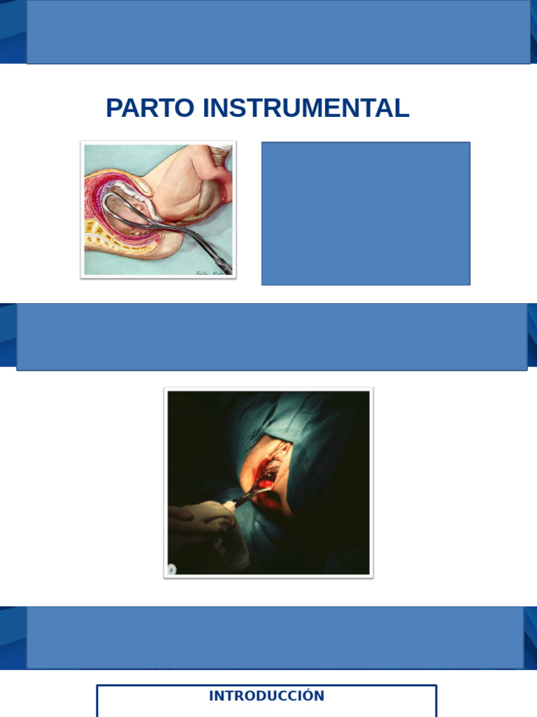 Parto Instrumental | PDF | Maternidad | Enfermedades y trastornos