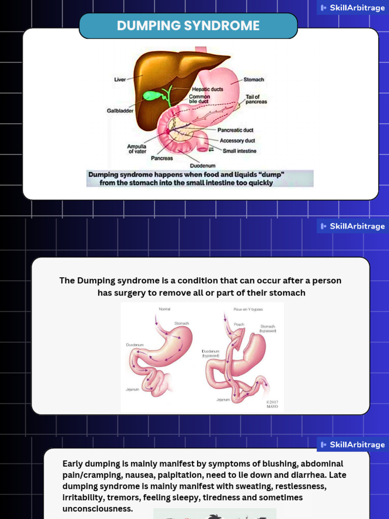 Dumping Syndrome | PDF