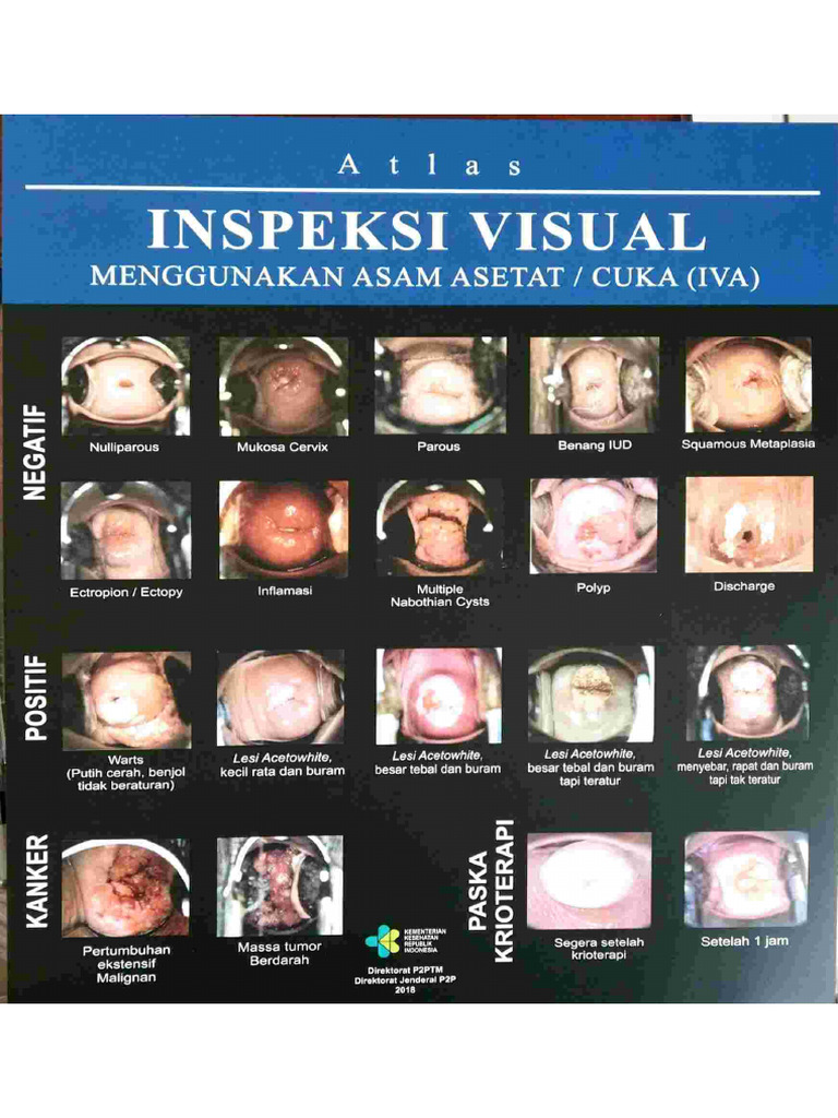 Atlas IVA (Inspeksi Visual Asam Asetat) | PDF