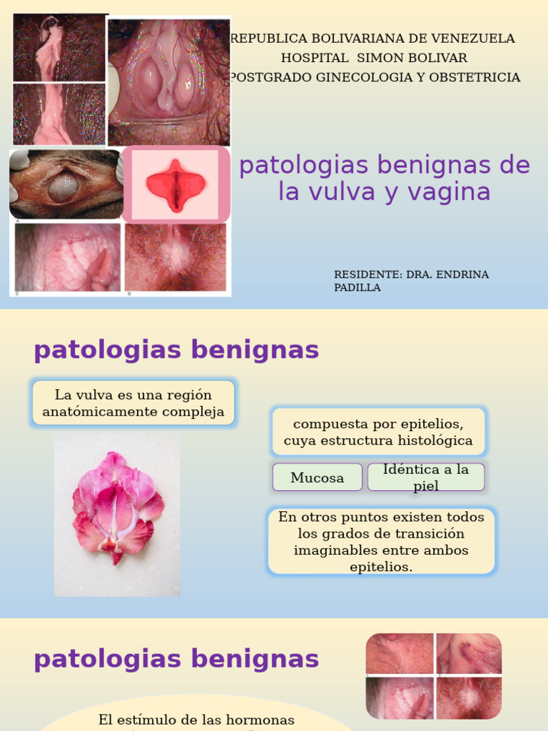 patologia benigna de la vulva | PDF | Vagina | Neoplasias