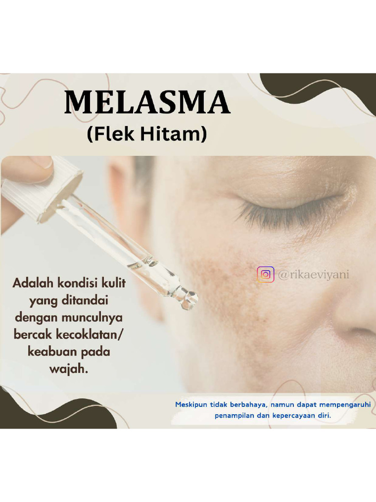 Melasma | PDF