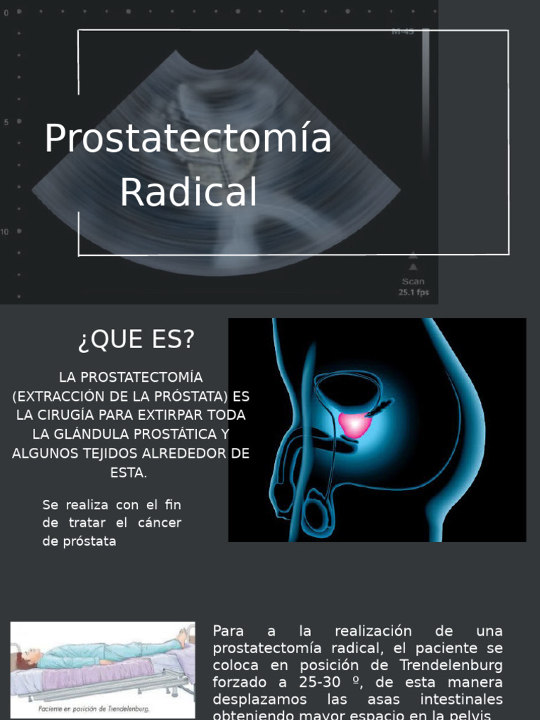 Prostectomia | PDF | Sistema genitourinario | Especialidades Medicas