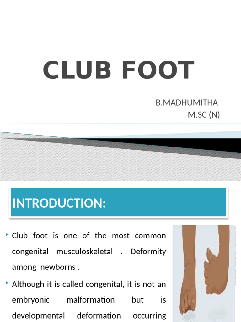 CLUB FOOT | PDF | Diseases And Disorders | Pediatrics
