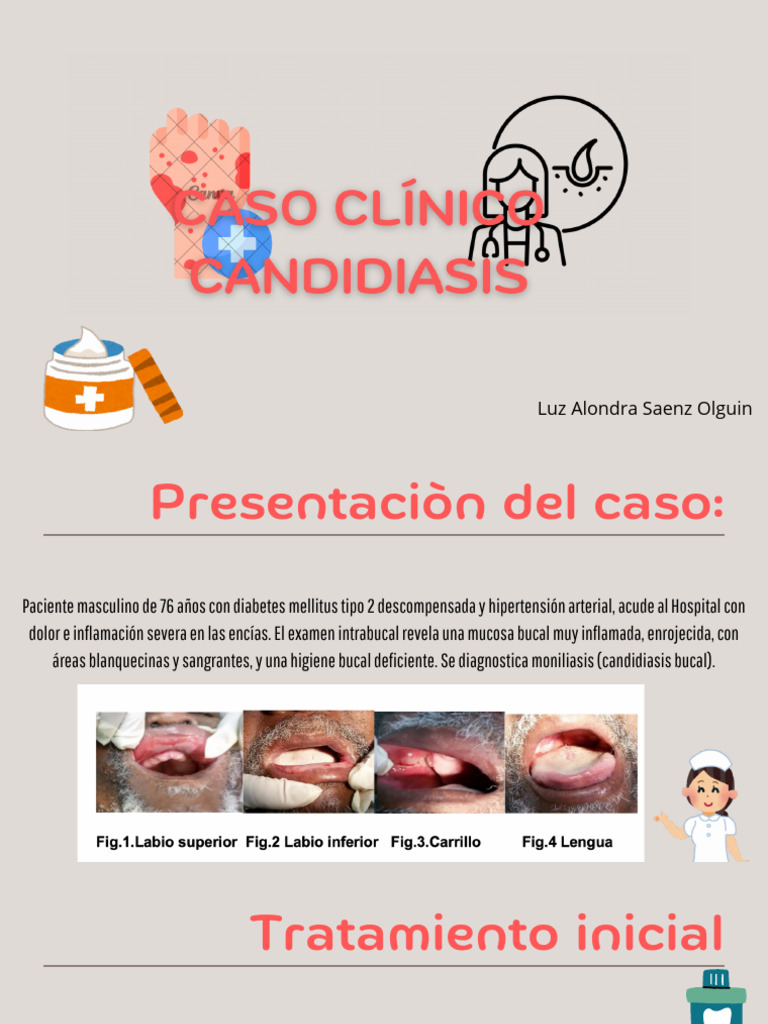 Candidiasis | PDF