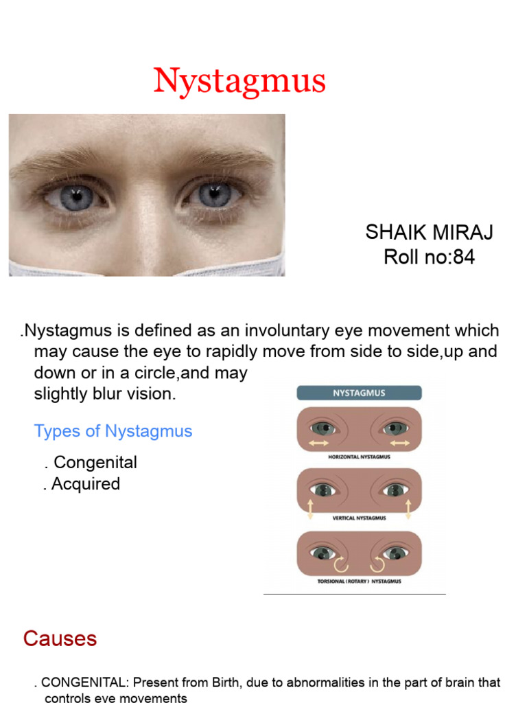 Nystagmus | PDF
