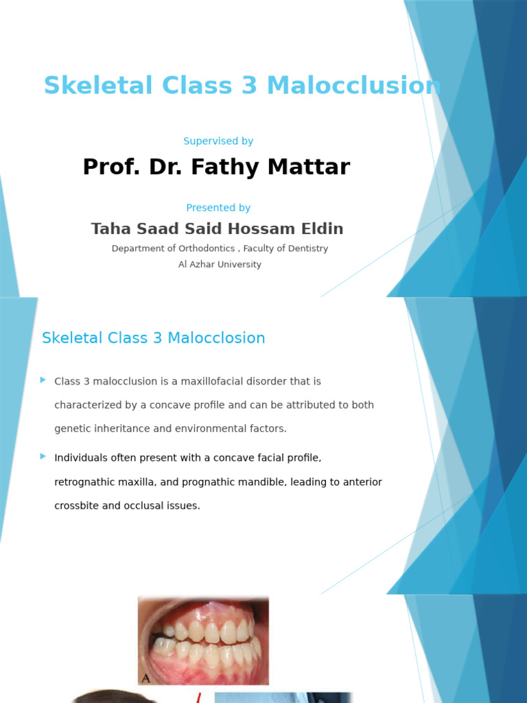 Understanding Skeletal Class 3 Malocclusion | PDF | Osteoblast