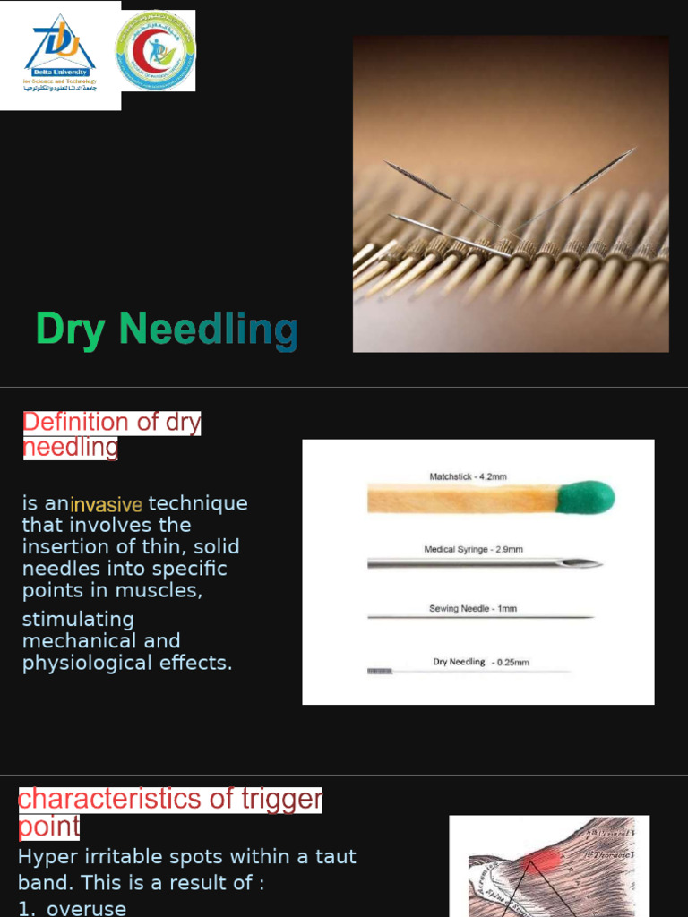 Benefits of Dry Needling Therapy | PDF | Pain | Myofascial Trigger Point