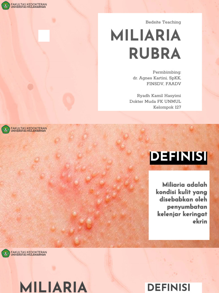 Miliaria Rubra | PDF