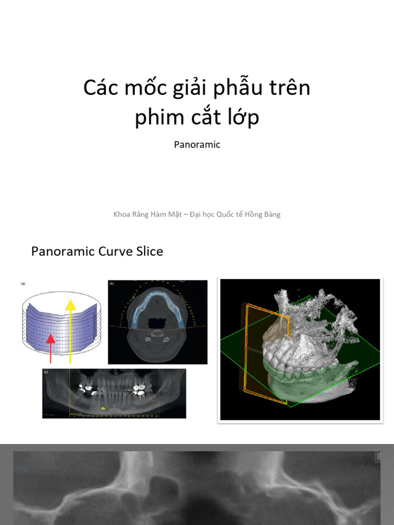 3.2. CÁC CẤU TRÚC GIẢI PHẪU TRÊN PANORAMIC | PDF