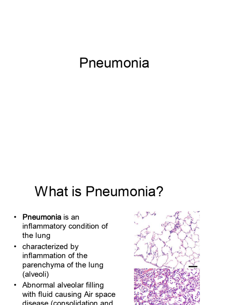 pneumonia handouts | PDF | Pneumonia | Influenza